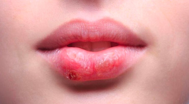Herpes labial: Conozca qué es, cómo prevenirlo y su tratamiento